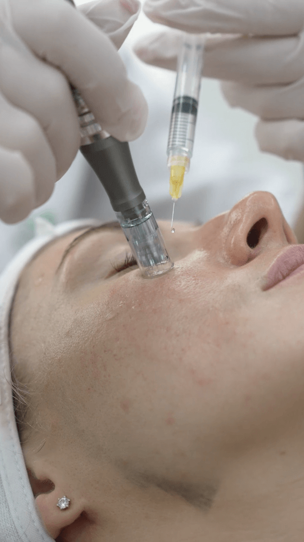 PRP Mesotherapy Treatments | DNA Health & Wellness Clinics