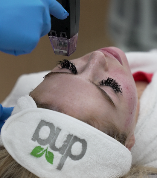 Morpheus8 Pro Treatment | DNA Health Clinics Dubai, UAE